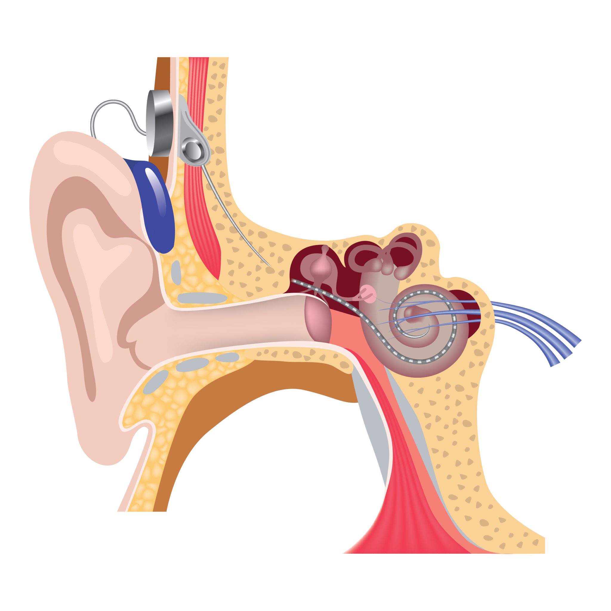 Understanding Cochlear Implants: Exploring How They Transform Hearing ...